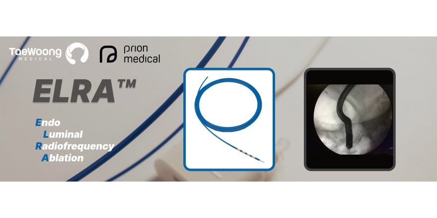 Intraductal radiofrequency ablation plus biliary stent versus stent ...